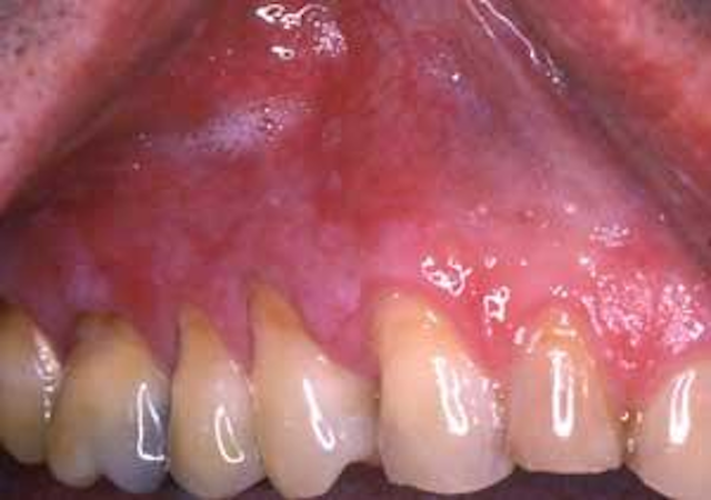 Lichenoid Reactions | Registered Dental Hygienist (RDH) Magazine