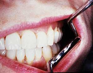 Scleroderma | Registered Dental Hygienists