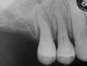 Scleroderma | Registered Dental Hygienists