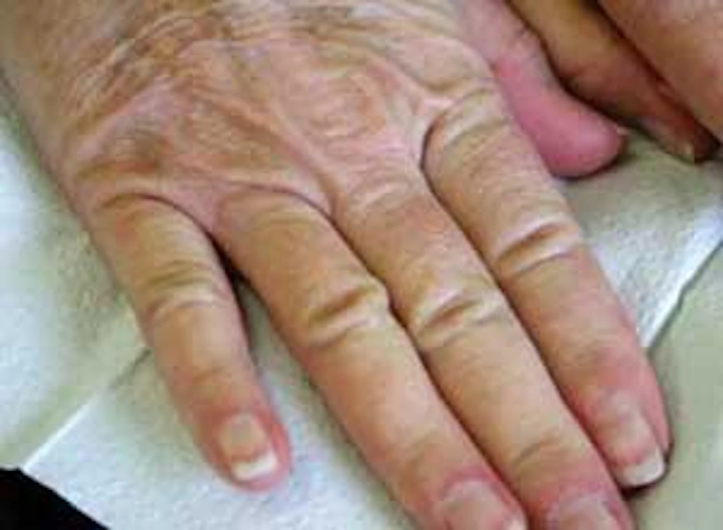Scleroderma | Registered Dental Hygienist (RDH) Magazine