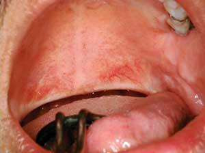The Uvula | Registered Dental Hygienists