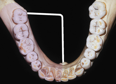 The underused block: The Vazirani-Akinosi mandibular block is a viable ...