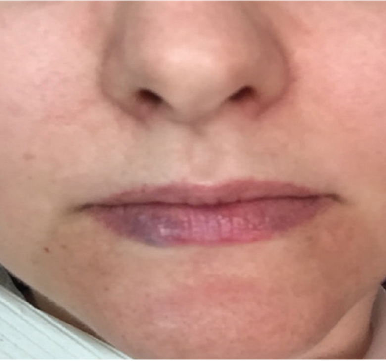 Why Do I Have Blue Spots On My Lips | Lipstutorial.org