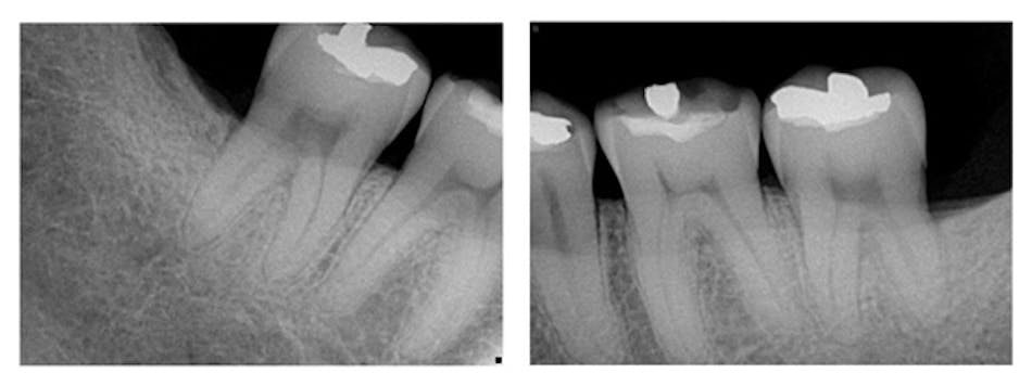 Nonsurgical attachment gain: A protocol for achieving periodontal ...