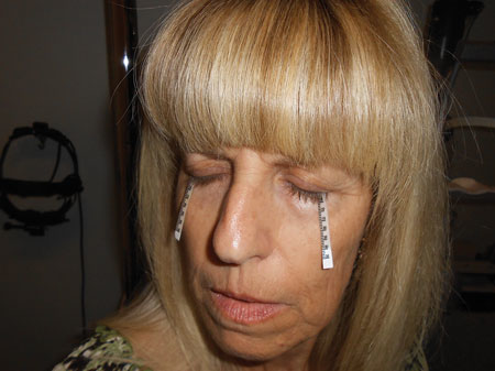 Skin Webbing Between Eyes And Base Of Nose