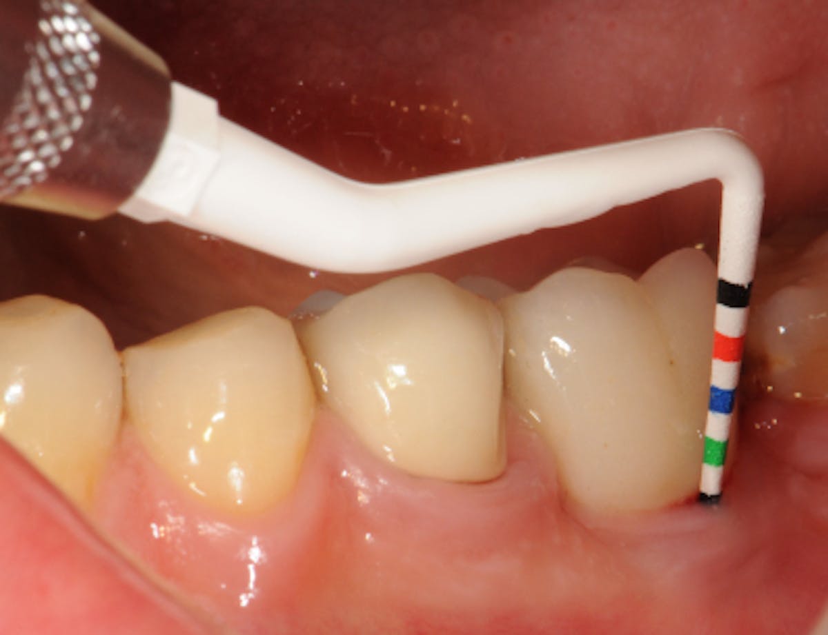 Probe selection: A hygiene team's review of periodontal probes ...
