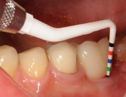 Probe selection: A hygiene team's review of periodontal probes ...