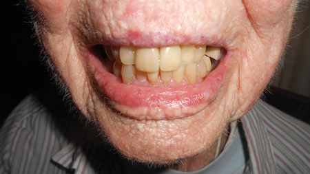 Living to 100: Data about centenarians provide valuable oral health ...