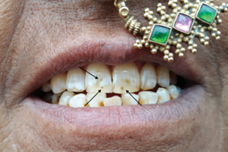 Gold Tooth Tattoos