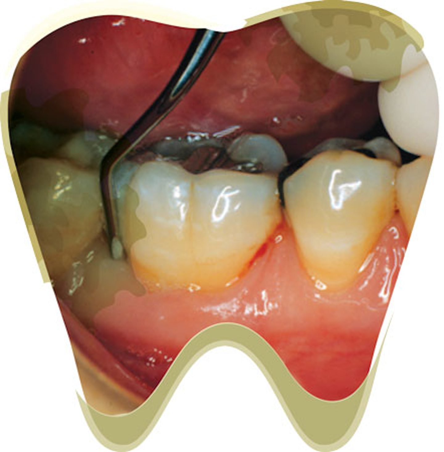 The role of hygienists in recognizing and healing supervised neglect ...