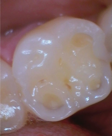 What is the cause of enamel loss? Exam process examines impact on oral ...