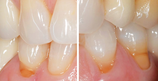 Disappearing tooth structure: What's a clinician to do about abfraction ...