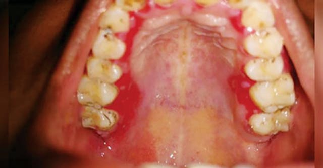 Vision loss from MMP | Registered Dental Hygienists