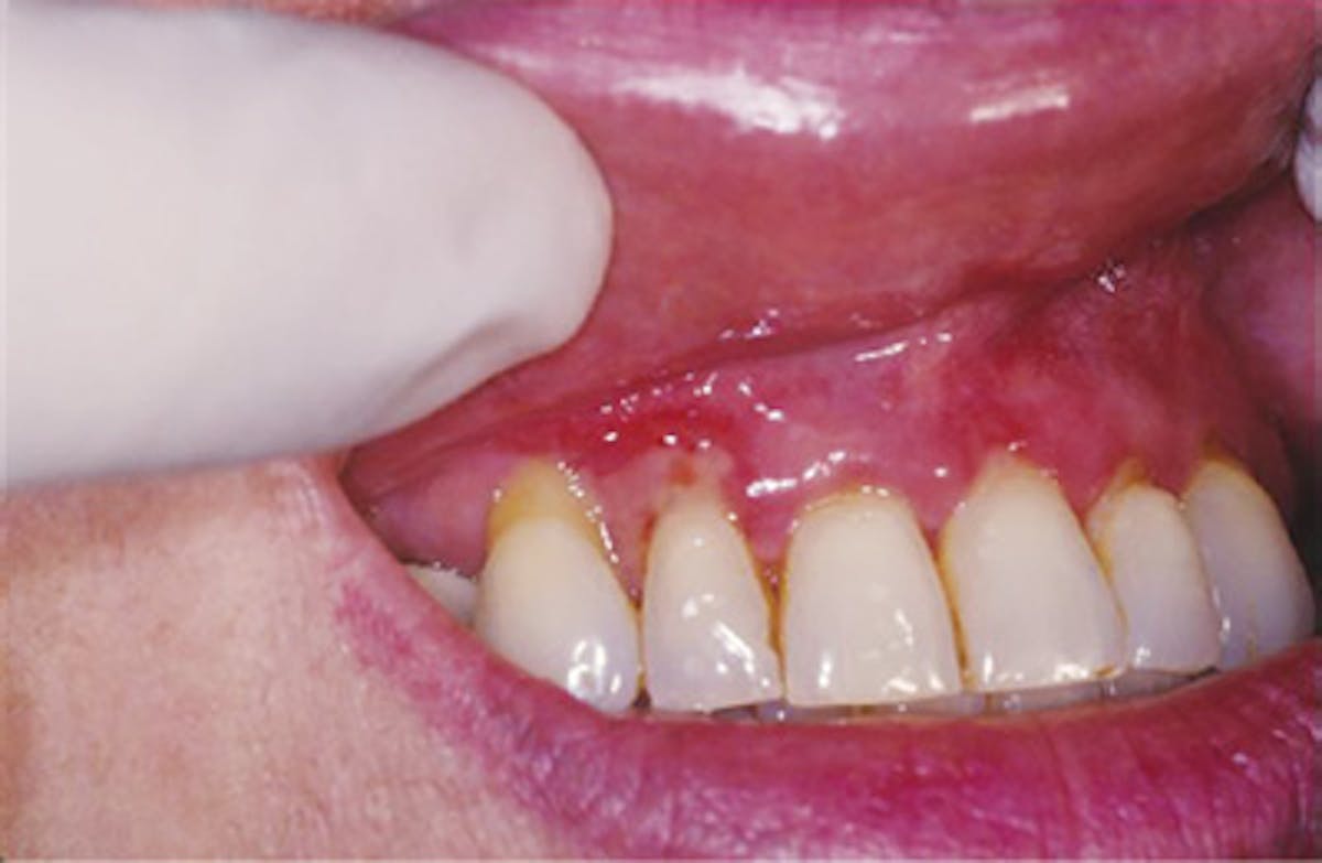 Vision loss from MMP | Registered Dental Hygienists