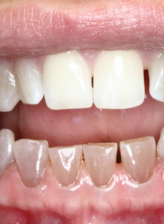 Osteogenesis Imperfecta Teeth Implication Of Brittle Bone Diseases