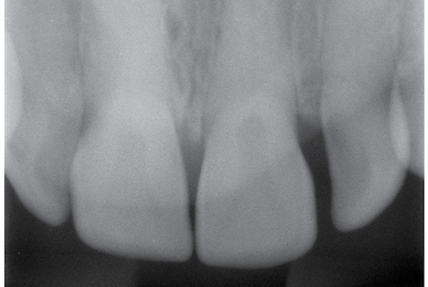 Implication of brittle bone diseases | Registered Dental Hygienist (RDH ...