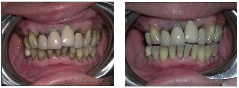 Clinical Pearls – Coronal Polishing | Registered Dental Hygienists