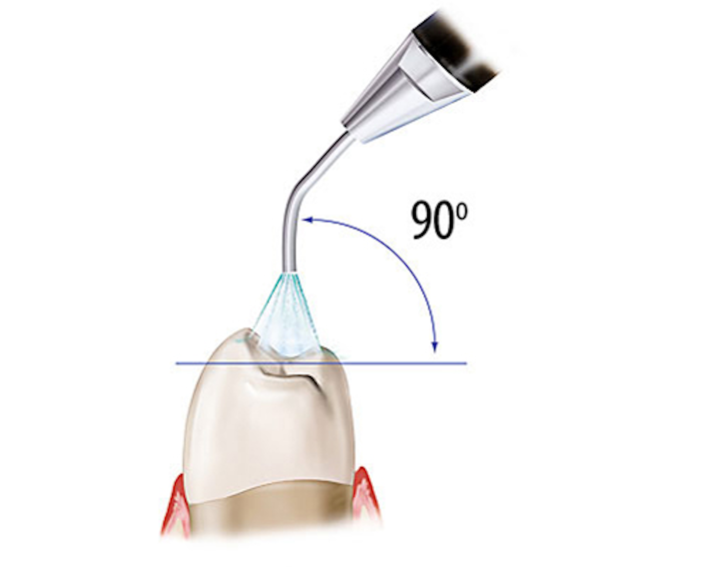Incorporating air polishing into daily practice | Registered Dental ...