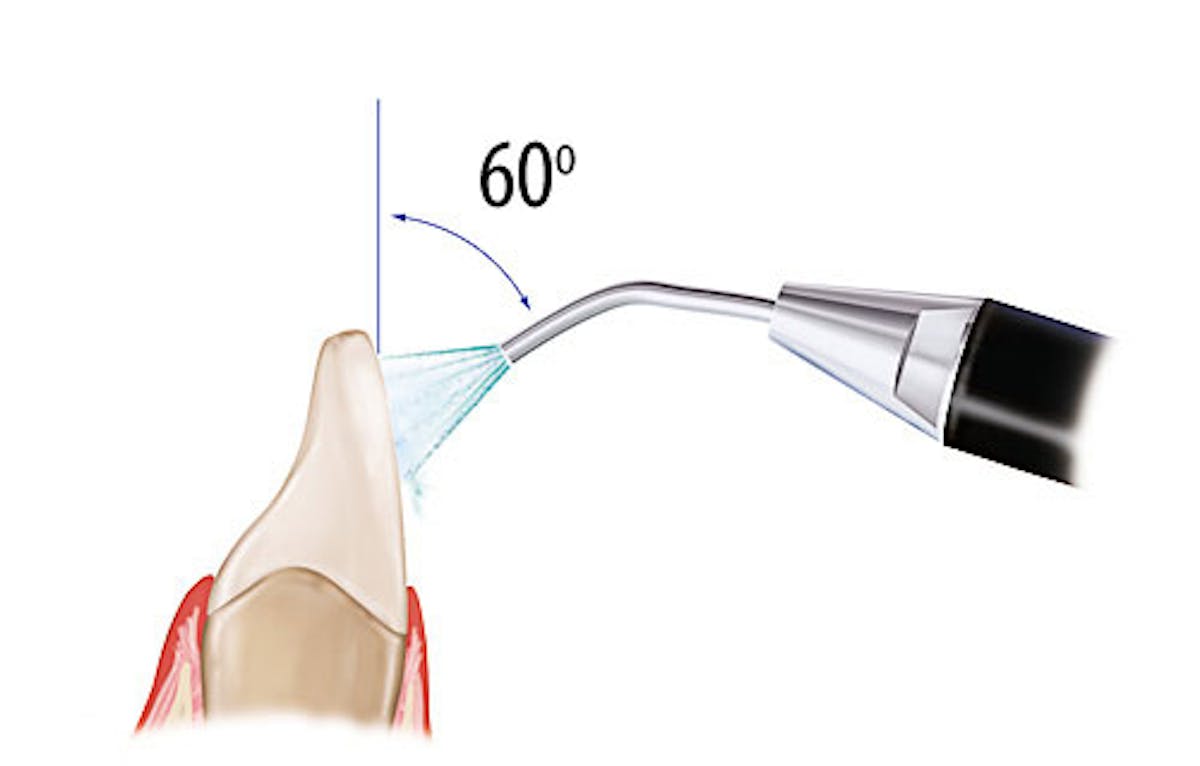 Incorporating air polishing into daily practice | Registered Dental ...