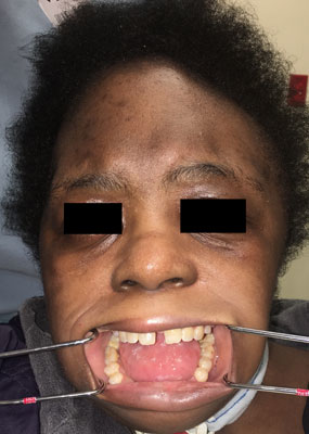 Macroglossia and the disease implications | Registered Dental Hygienists