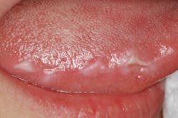 Macroglossia and the disease implications | Registered Dental Hygienists