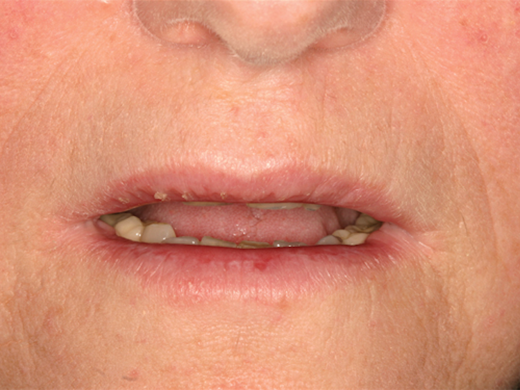 Exfoliative cheilitis and lip damage | Registered Dental Hygienists