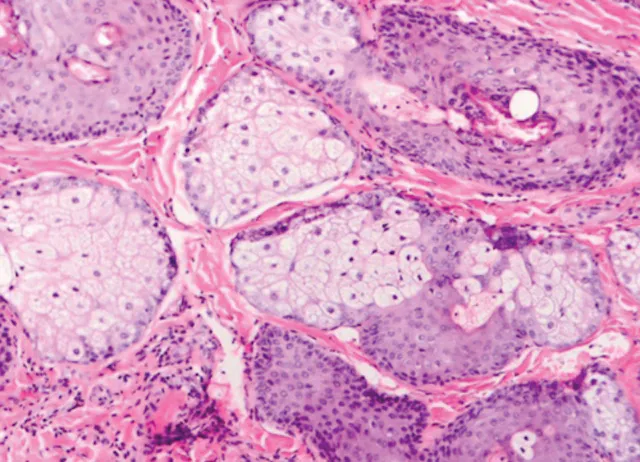 Fordyce granules: Normal or abnormal structures? | Registered Dental ...