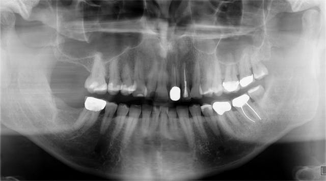 What are the implications of residual root sockets? | Registered Dental ...
