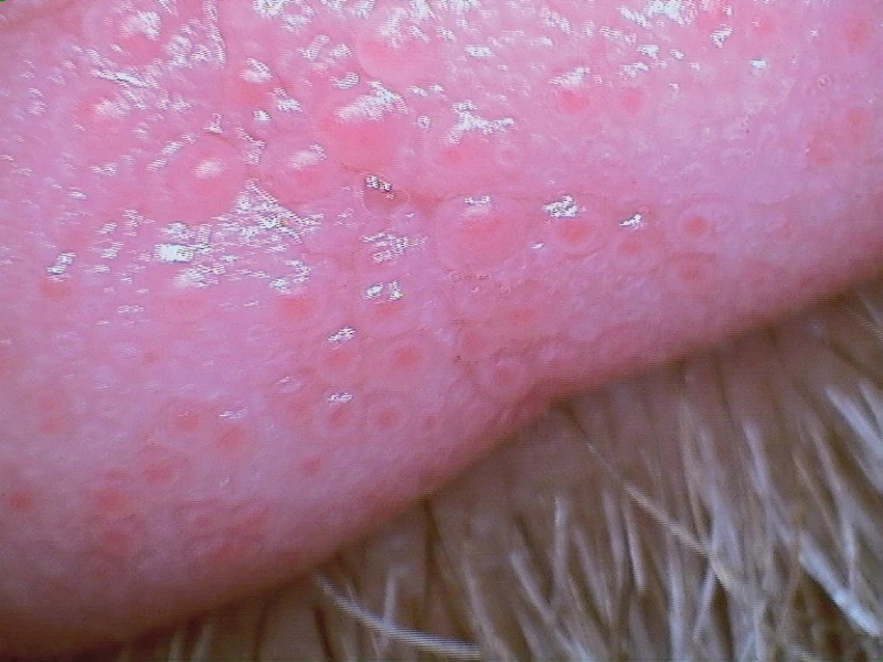 Pigmented Fungiform Papillae Or Papillary Tip Melanosis Registered Pigmented Fungiform Papillae Or Papillary Tip Melanosis Registered