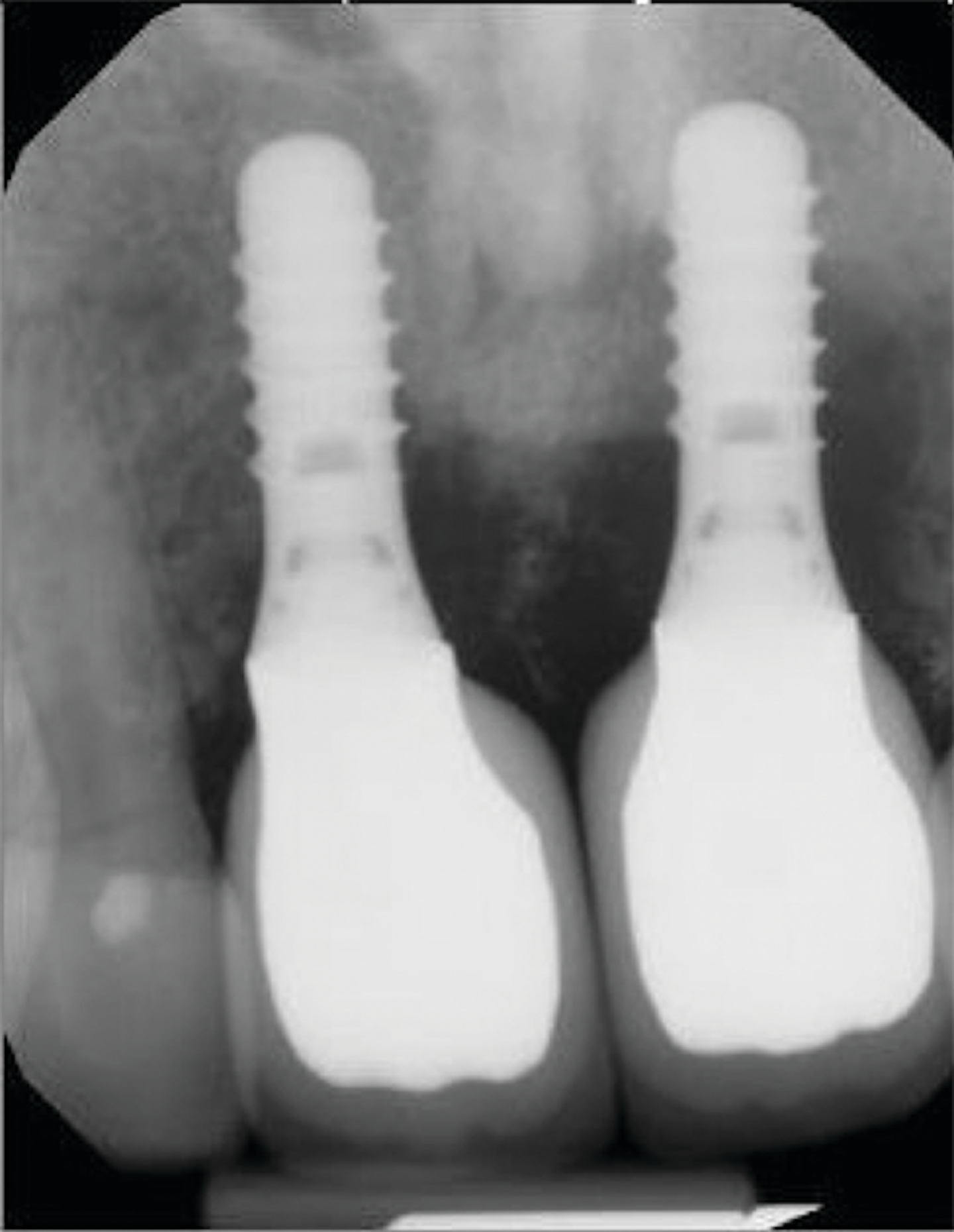 How dental hygienists can manage peri-implantitis patients | Registered ...