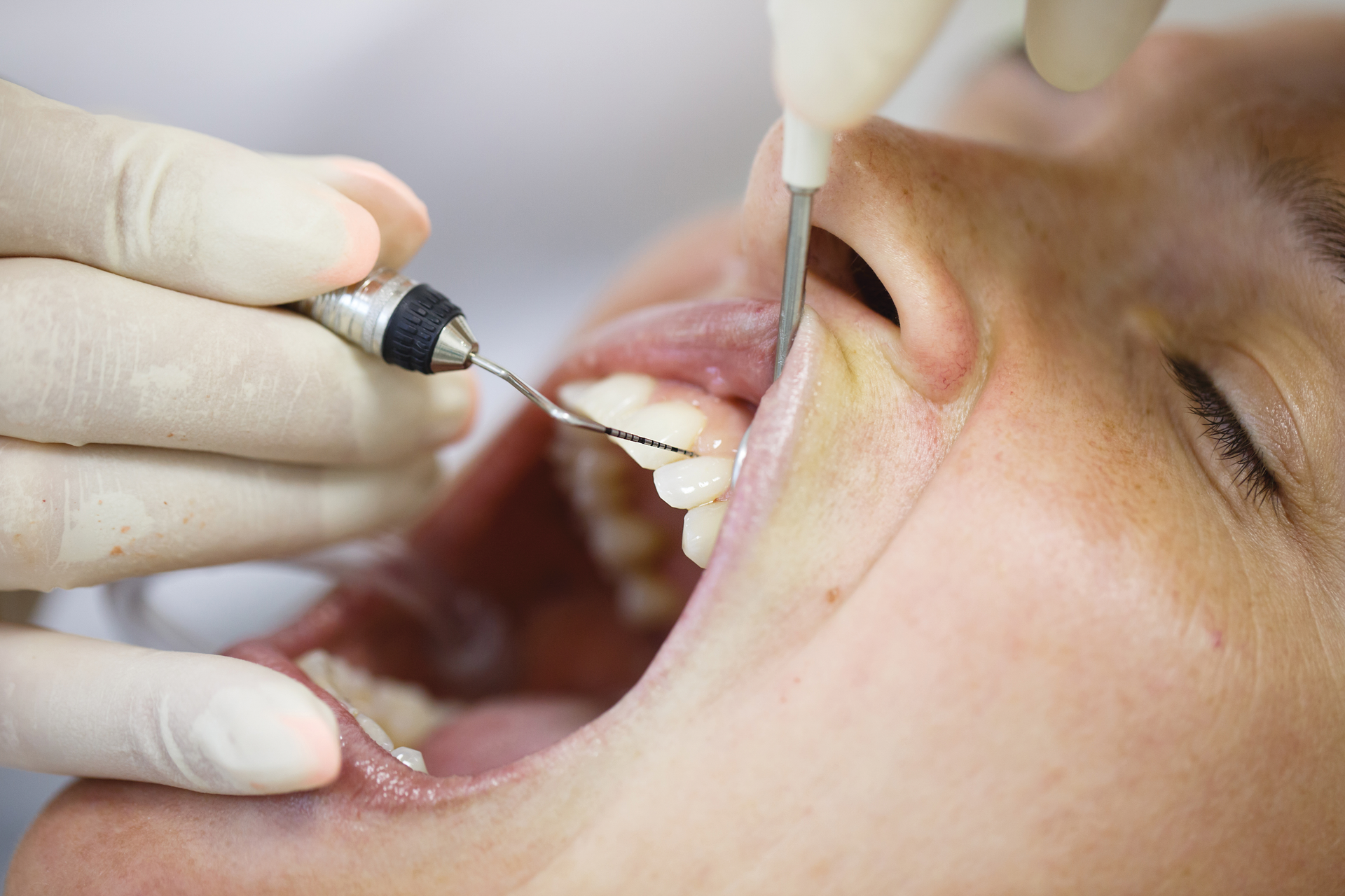 Standard of care for periodontal charting | Registered Dental Hygienists