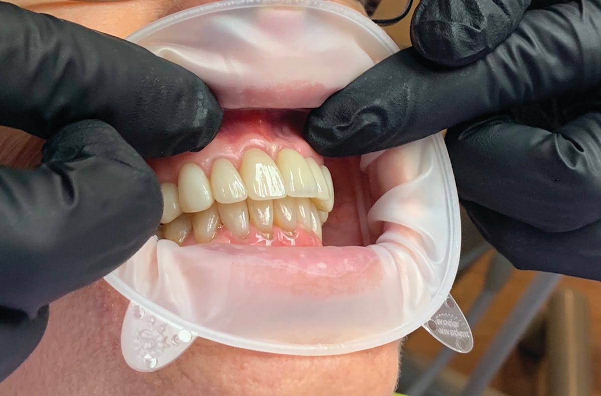 Maintenance and disease treatment protocols for natural teeth, implants ...