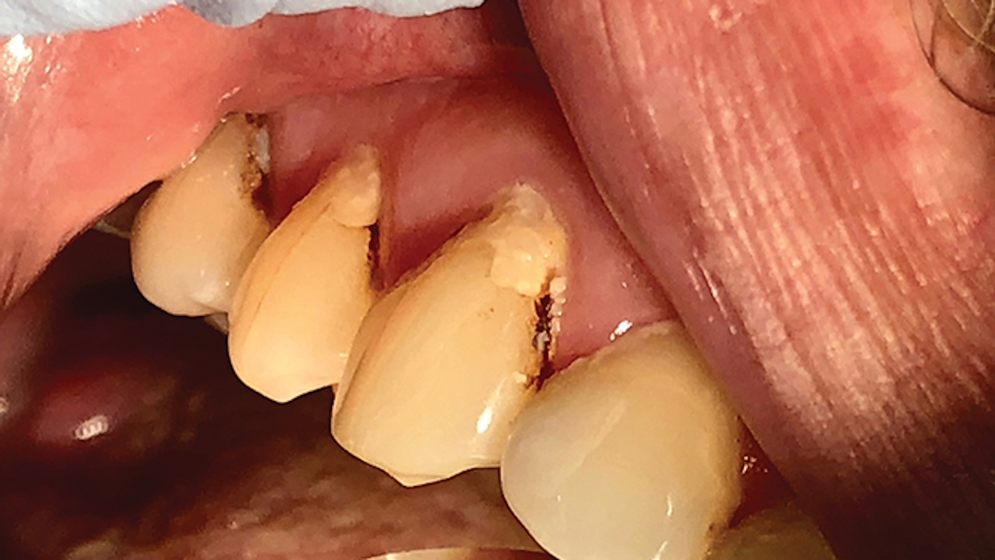 Silver diamine fluoride (SDF): Dental caries in older adult patients ...