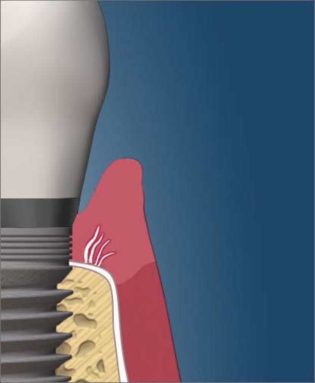 Preventive care and a fixed implant denture | Registered Dental Hygienists