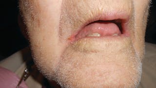 angular cheilitis complications