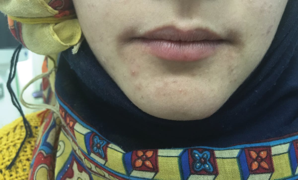 The multiple etiologies of angular cheilitis | Registered Dental Hygienists