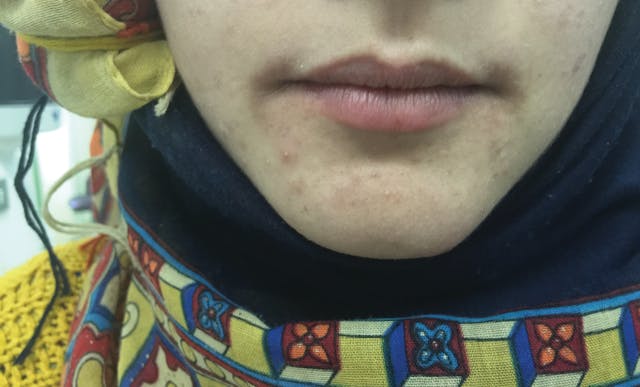 The multiple etiologies of angular cheilitis | Registered Dental Hygienists