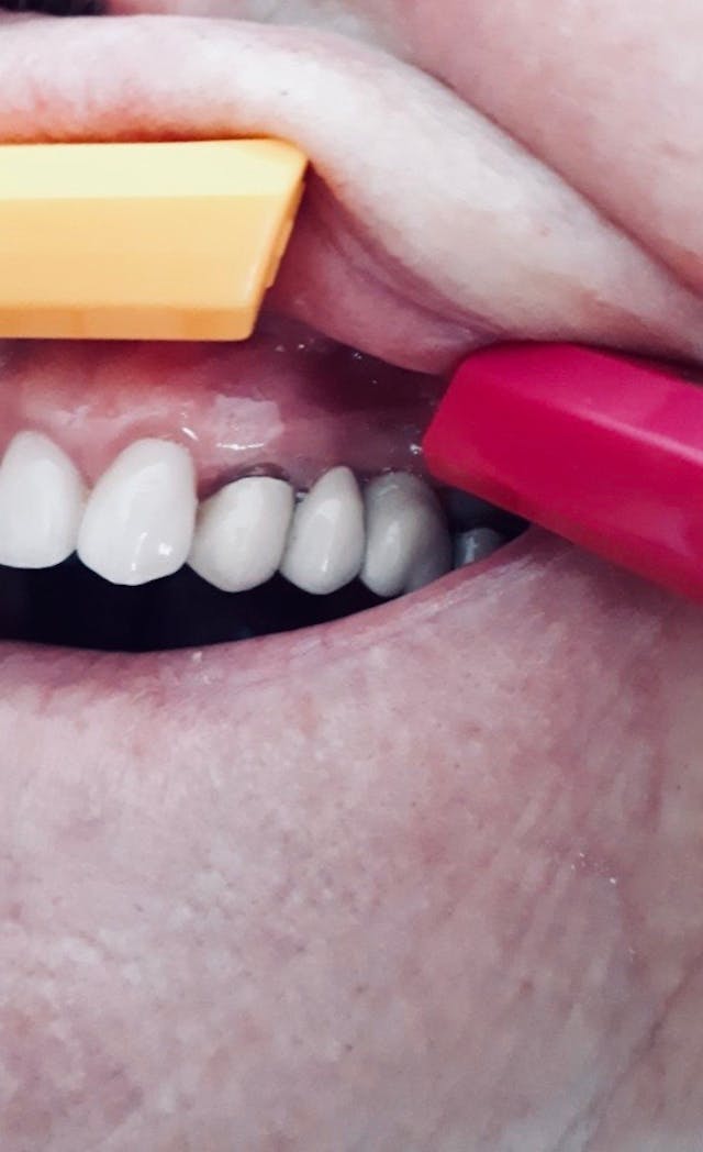 A change in practice: Reducing the burden of dental caries with silver ...