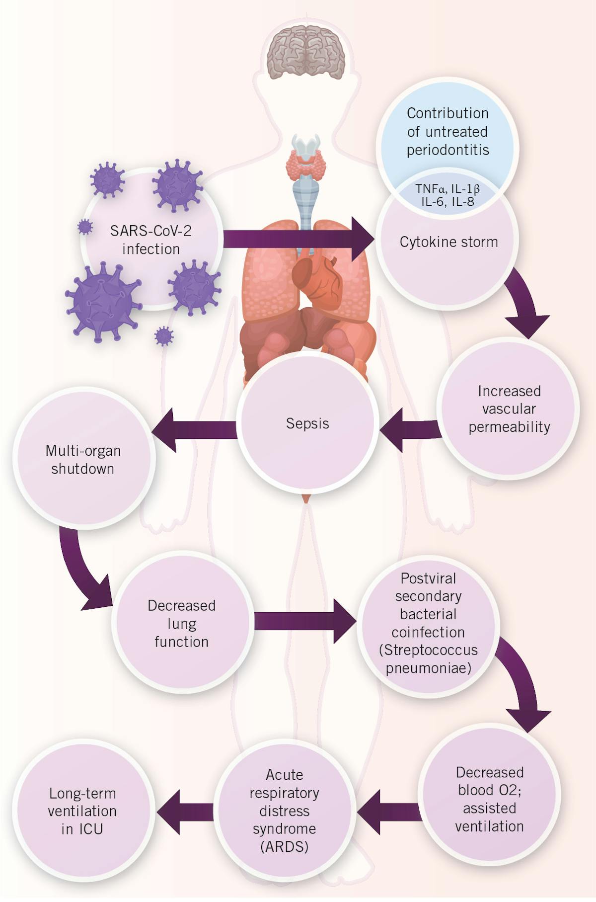 Untreated periodontitis and COVID-19: What is the evidence? Part 1 of 3 | Registered Dental ...