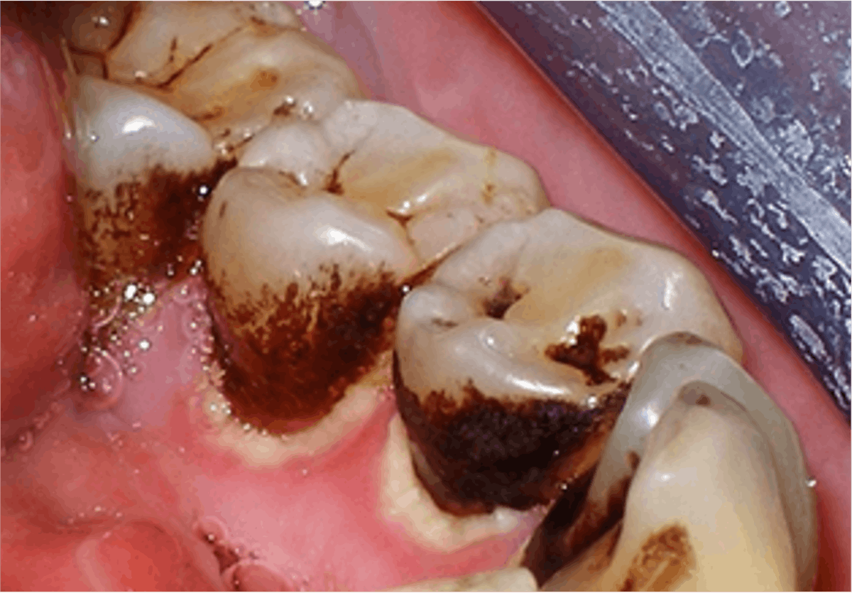 Removing stains from teeth: A guide for clinicians and patients ...