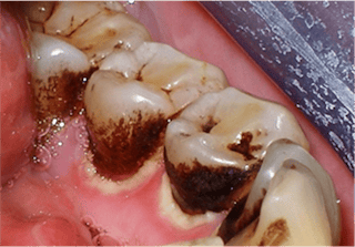 Removing stains from teeth: A guide for clinicians and patients ...