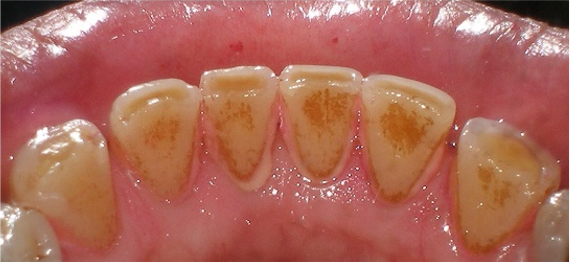 Removing stains from teeth: A guide for clinicians and patients ...