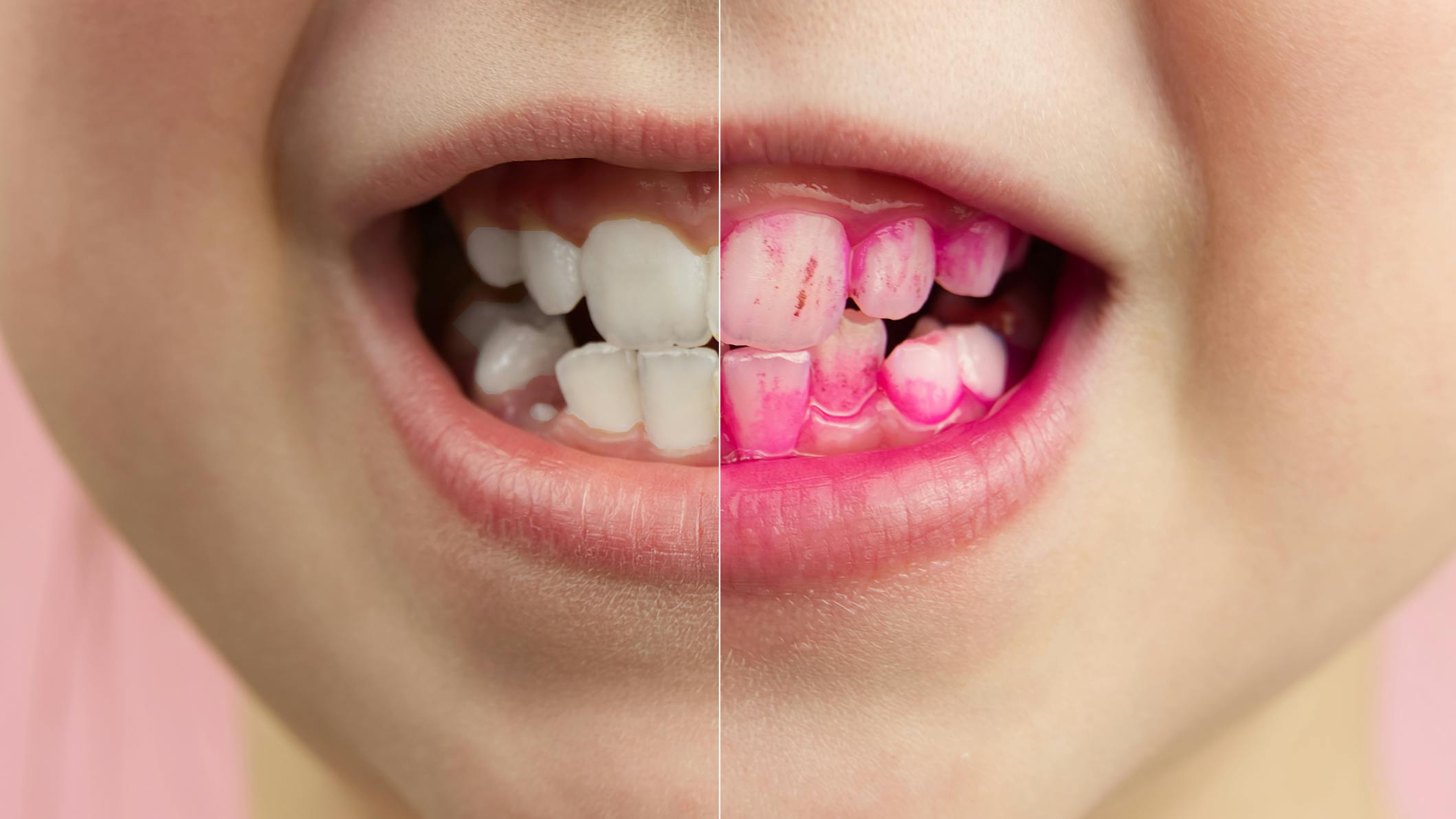 Not using disclosing solution on every patient? Here’s why you should ...