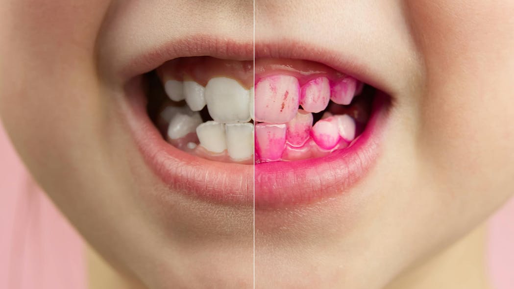 Not using disclosing solution on every patient? Here’s why you should ...