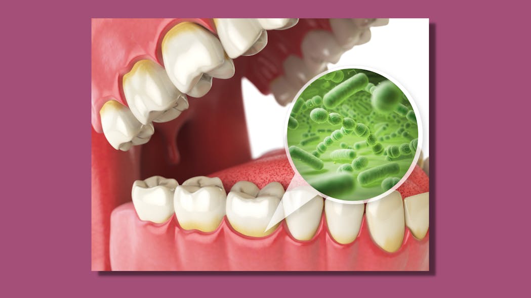 Understanding dental biofilm and guided biofilm therapy | Registered ...