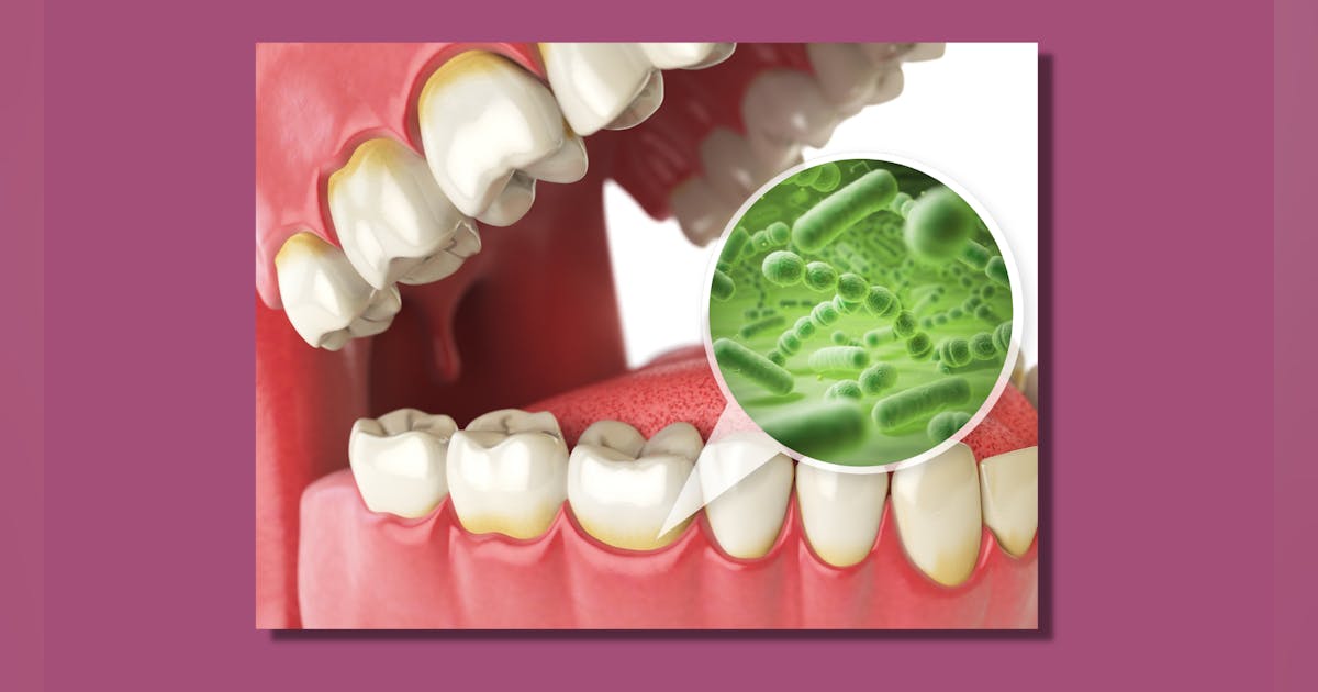 Understanding dental biofilm and guided biofilm therapy | Registered ... Understanding dental biofilm and guided biofilm therapy | Registered ...