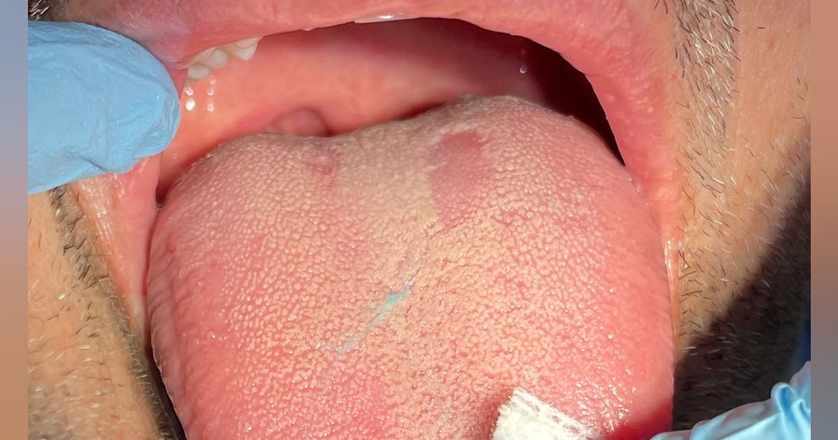 On The Tip Of My Tongue Differential Diagnoses For Tongue Lesions on-the-tip-of-my-tongue-differential-diagnoses-for-tongue-lesions