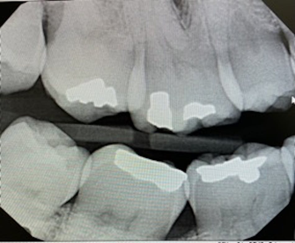 Techniques to reduce horizontal overlap in dental x-rays | Registered ...