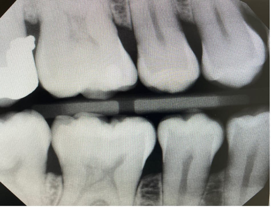 Techniques to reduce horizontal overlap in dental x-rays | Registered ...