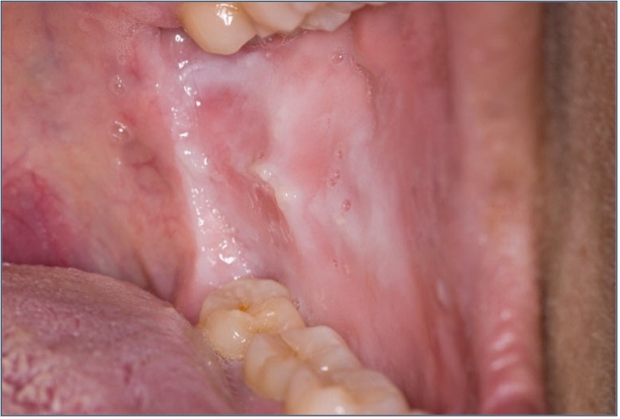 White Spots On Buccal Mucosa White And Red Lesions Of The Oral Mucosa